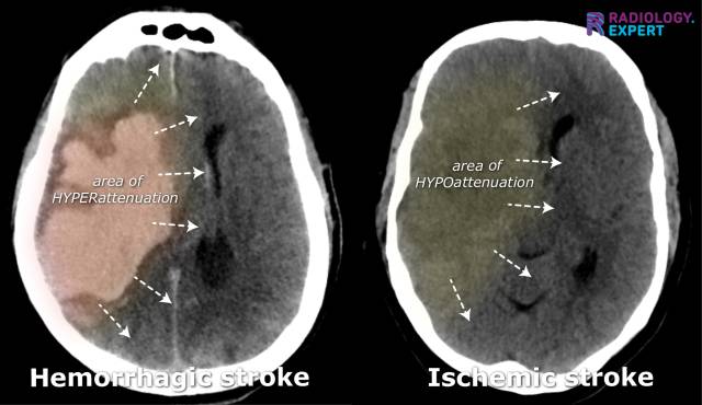 Interventional Radiology - The Stroke Patient
